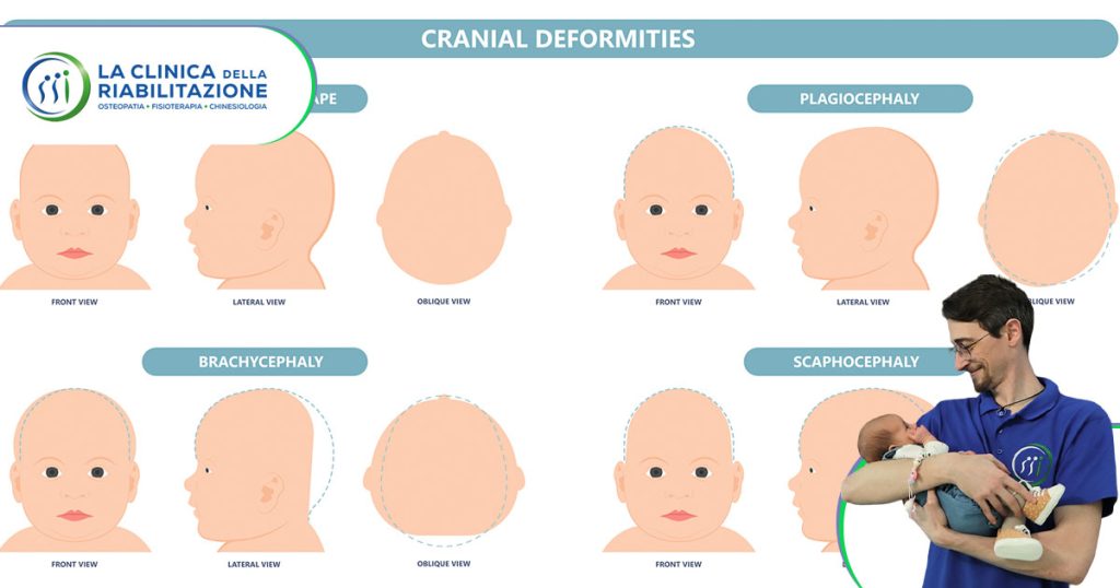 Plagiocefalia e consigli per i genitori | La Clinica della Riabilitazione